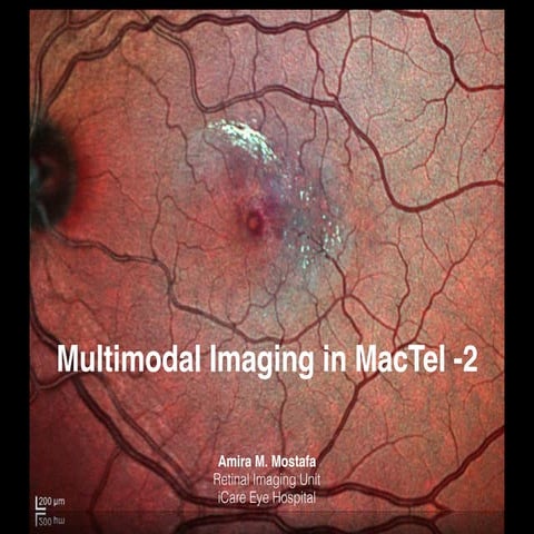 Multimodal imaging in MacTel-2 | PDF