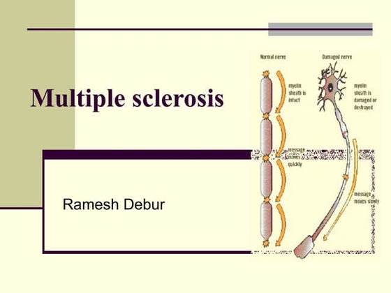 Sudeck's atrophy or Chronic regional pain syndrome.pptx