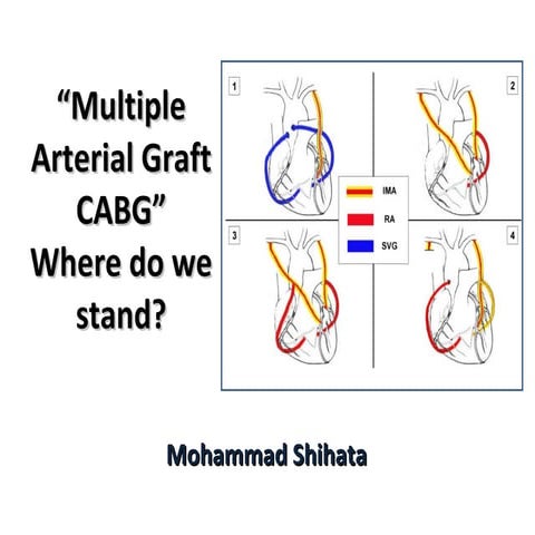 Coronary Artery Bypass Graft (CABG) Surgery
