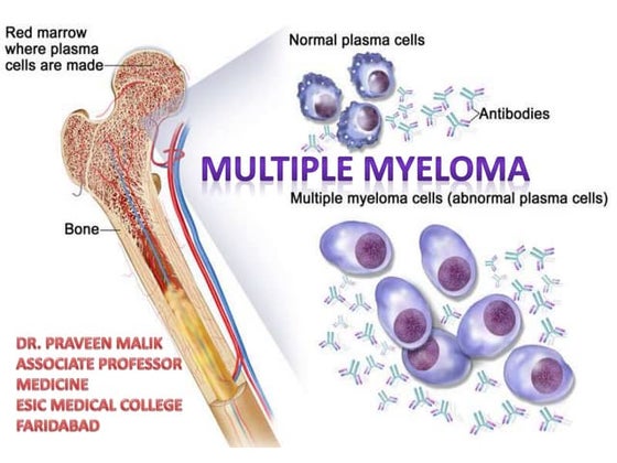 Multiple myeloma by sathiya | PPTX | Blood Disorders | Diseases and ...