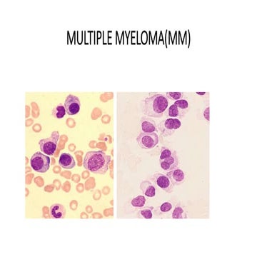 Myeloma | PPTX