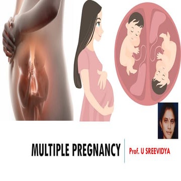 Multiple_Pregnancy_Lecture.ppt TWIN GESTATION | PPT