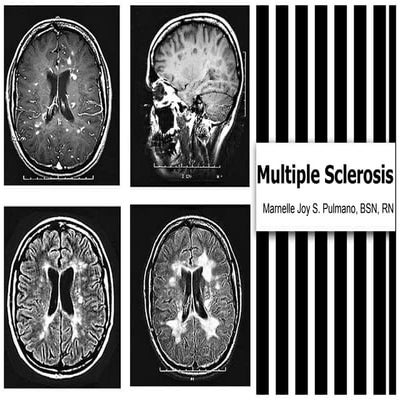 Multiple sclerosis | PPTX