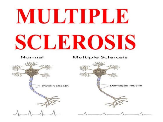 Multiple Sclerosis Pptx