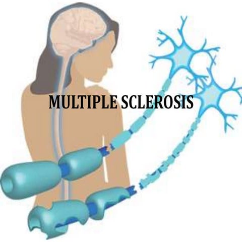 Multiple sclerosis | PPTX