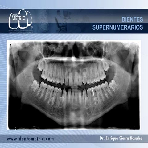 Multiples supernumerarios | PPTX
