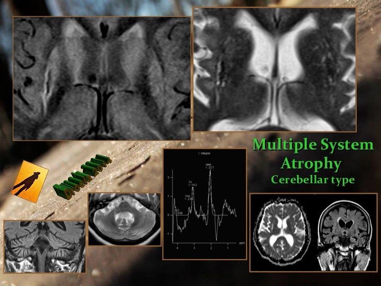 Multiple System Atrophy Cerebellar type