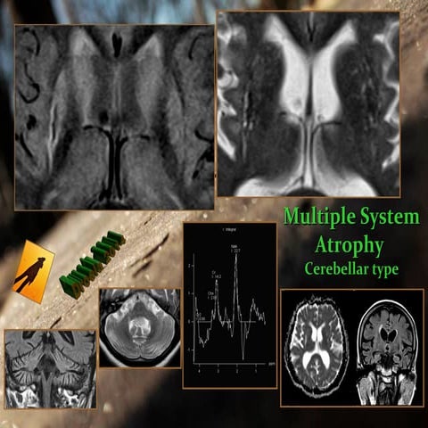 Multiple System Atrophy Cerebellar type | PPT