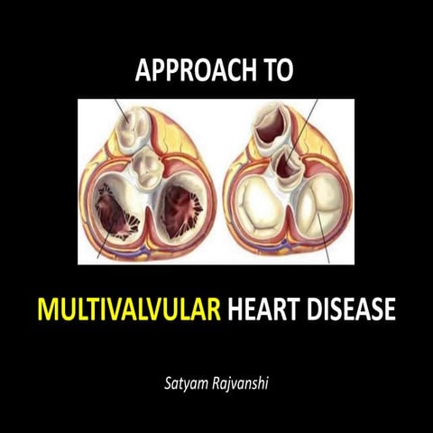 Clinical approach to multi valvular heart disease | PPTX