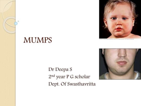 Mumps | PPT