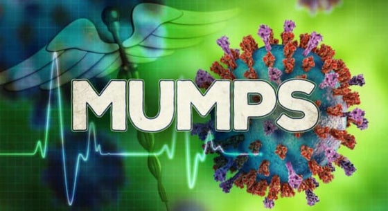 Mumps | PPT