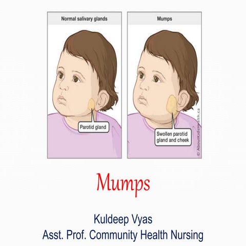 Parotid Gland Swelling Mumps