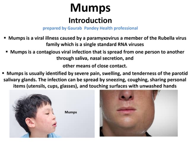 Mumps | PPTX