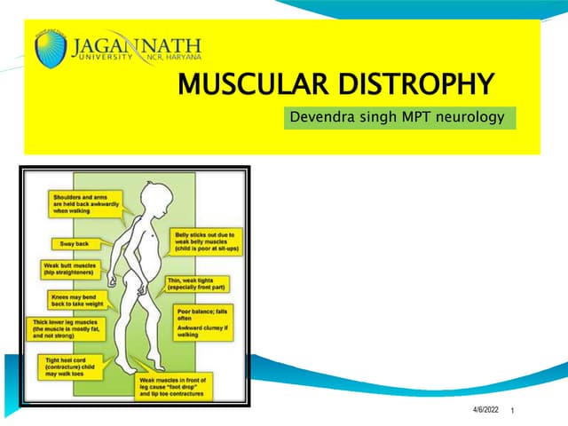 Duchenne Muscular Dystrophy | PDF