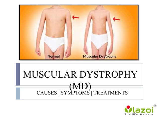 Muscular dystrophy | PPTX