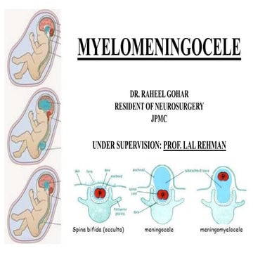 Myelomeningeocele by Dr. Raheel Gohar.pptx