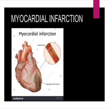 Myocardial infarction | PPTX