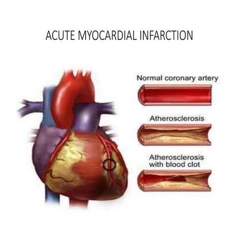 myocardialinfarction-copy-130618222123-phpapp02.pptx