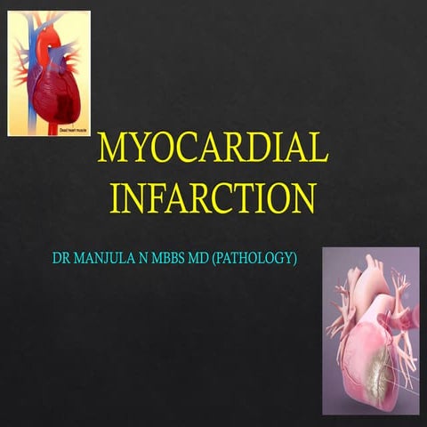 MYOCARDIAL INFARCTION THEORY .pptx