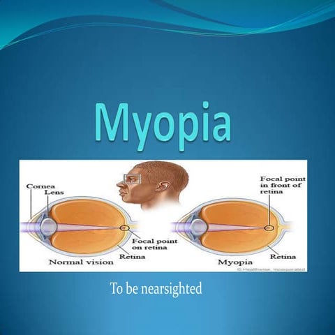 Myopia | PPT