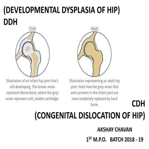 CDH AND DDH | PPTX