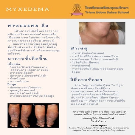 Myxedema | PDF
