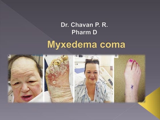 Myxoedema Coma Ppt