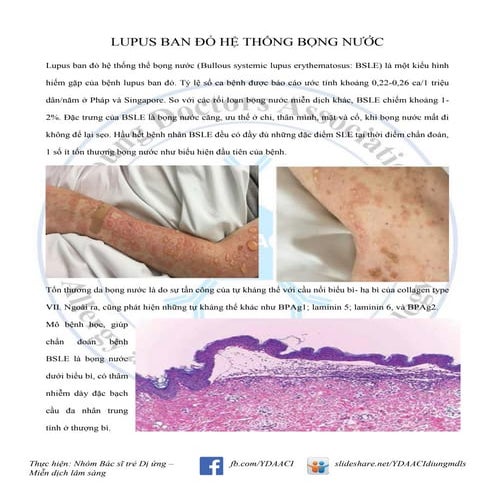 Lupus ban đỏ có bọng nước | PDF