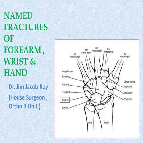 Named fractures of forearm ,wrist &and hand | PPTX