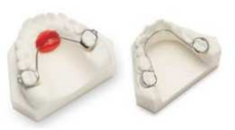 Glauser-Williams Orthodontics - Orthodontic Appliances - Space Mainte…