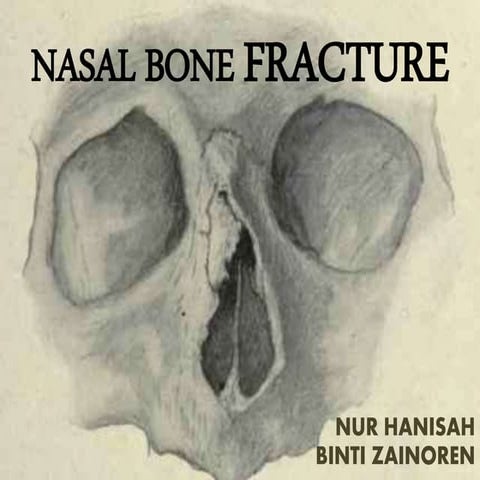 NASAL BONE FRACTURE | PPTX
