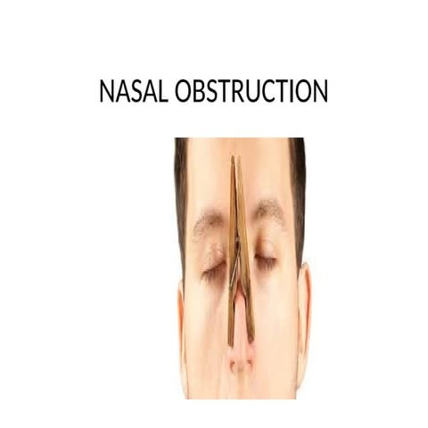 NASAL OBSTRUCTION.pptx GGGGGGGGGGGGGGGGGG | PPTX