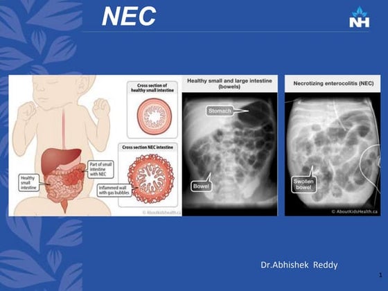 necrotizing ENTEROCOLITUS definition, incidence, pathophysiology, risk ...