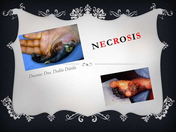 NECROSIS GANGRENOSA.pptx