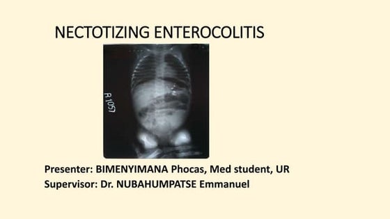 necrotizing ENTEROCOLITUS definition, incidence, pathophysiology, risk ...