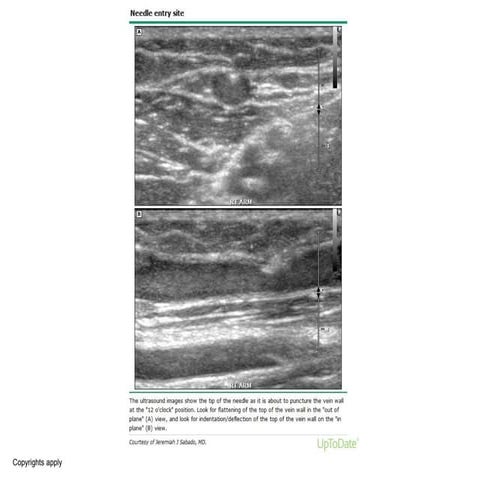 Needle entry site | PPT