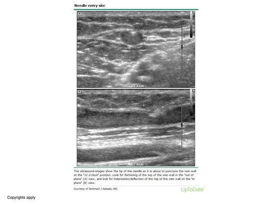Needle tip visualization | PPT