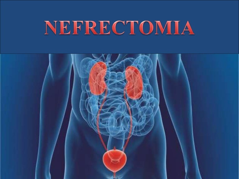 Nefrectomia repaginado