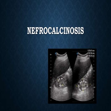 NEFROCALCINOSIS DATOS OBSERVADOS EN ULTRASONIDO.pptx
