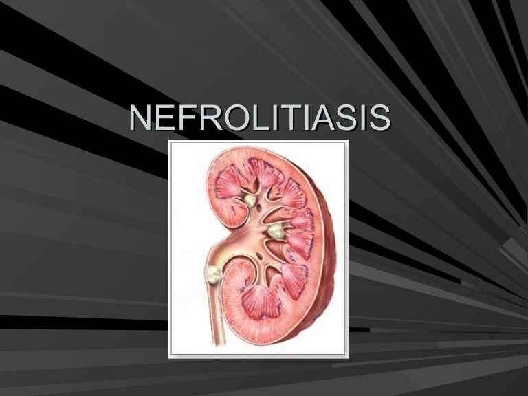 Nefrolitiasis