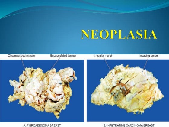 Neoplasia | PPT