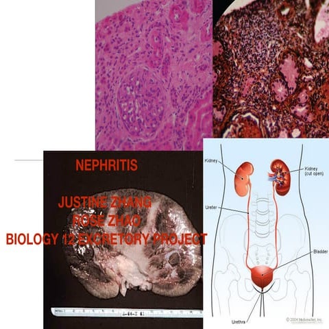 Nephritisperiod4 | PPT | Diseases and Conditions | Medical Health