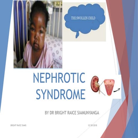 Nephrotic syndrome in Pediatrics | PPTX