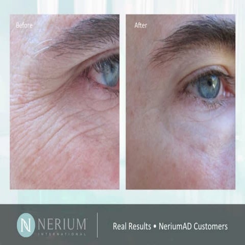 Nerium before and after results | PDF