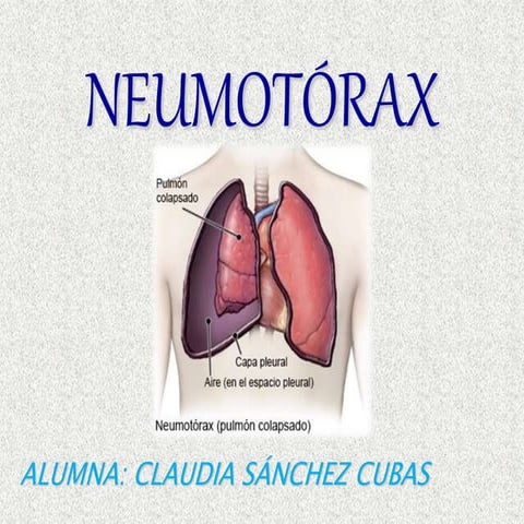 neumotorax.ppt