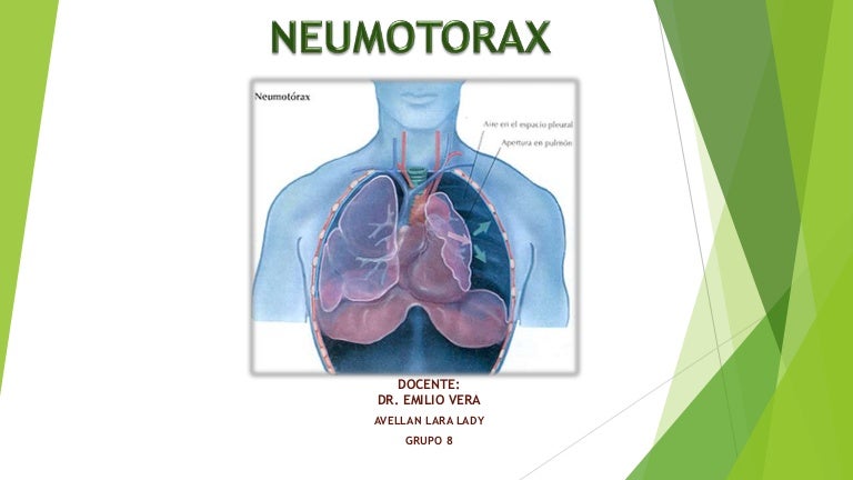 Neumotorax
