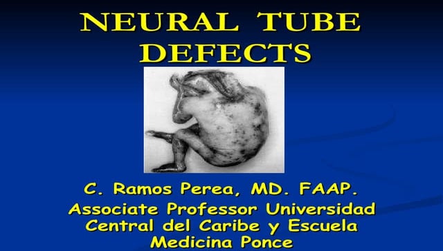 Neural tube defects a case series - copy