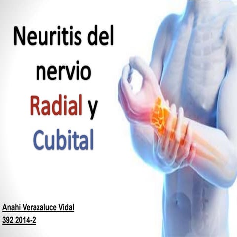 Neuritis del nervio radial y cubital | PPTX