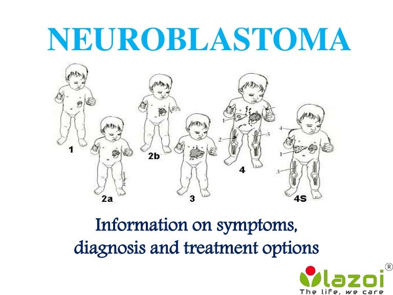 Neuroblastoma: Patient info on symptoms, diagnosis and treatment opti…