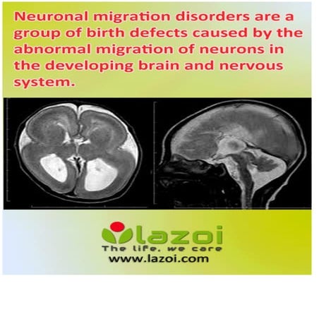Neuronal migration disorders | PDF